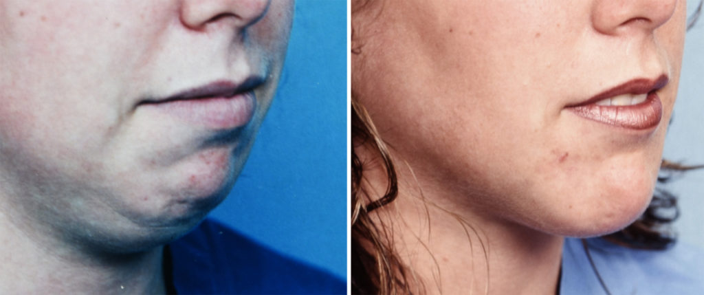 Plastic Surgery Case Study - Facial Slimming Surgery with Chin ...