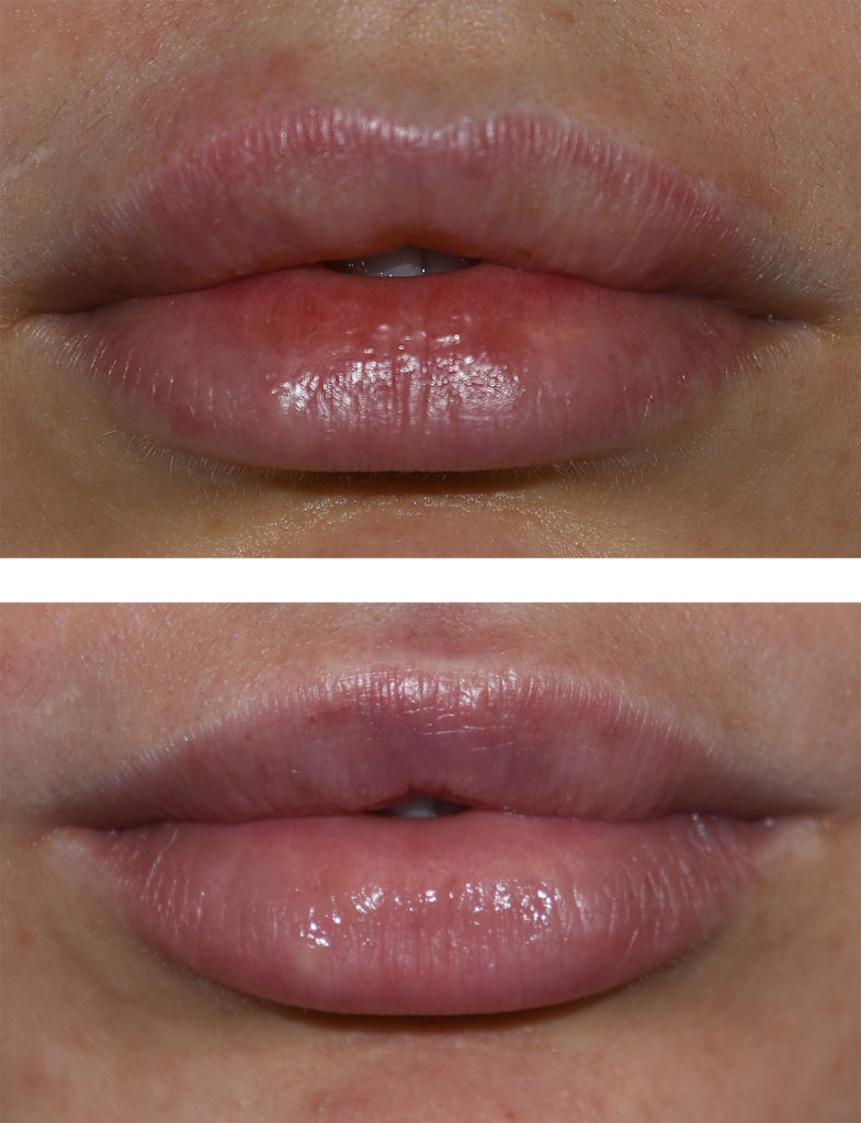 Clinic Snapshots Cupids Bow Reduction Result Explore Plastic Surgery 