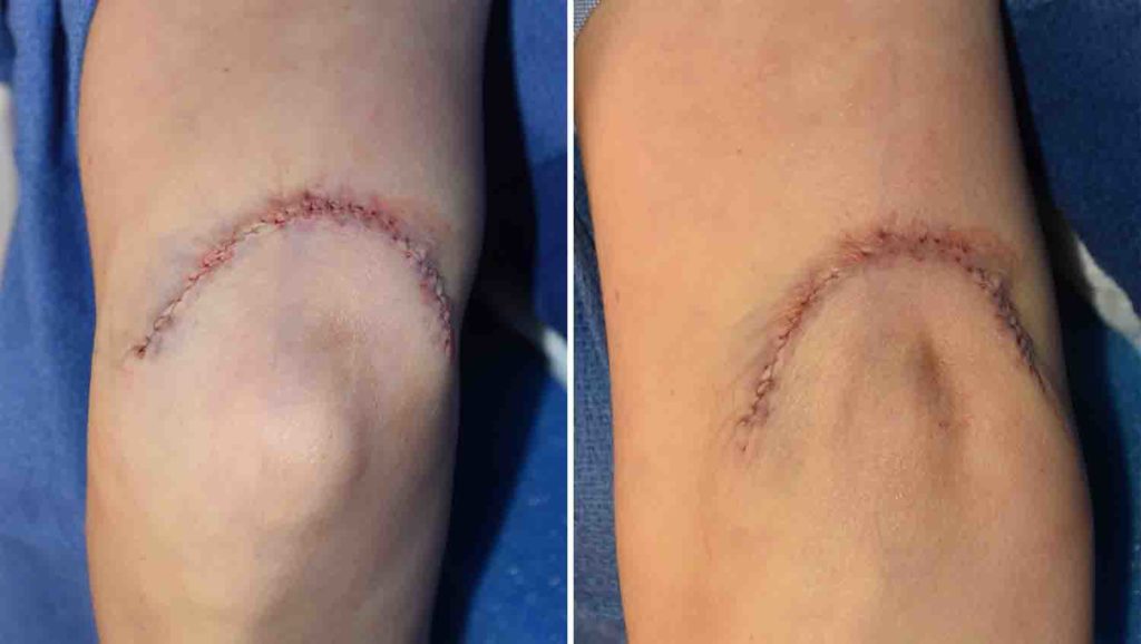 Plastic Surgery Case Study - Bilateral Elbow Lifts for Extension Skin ...