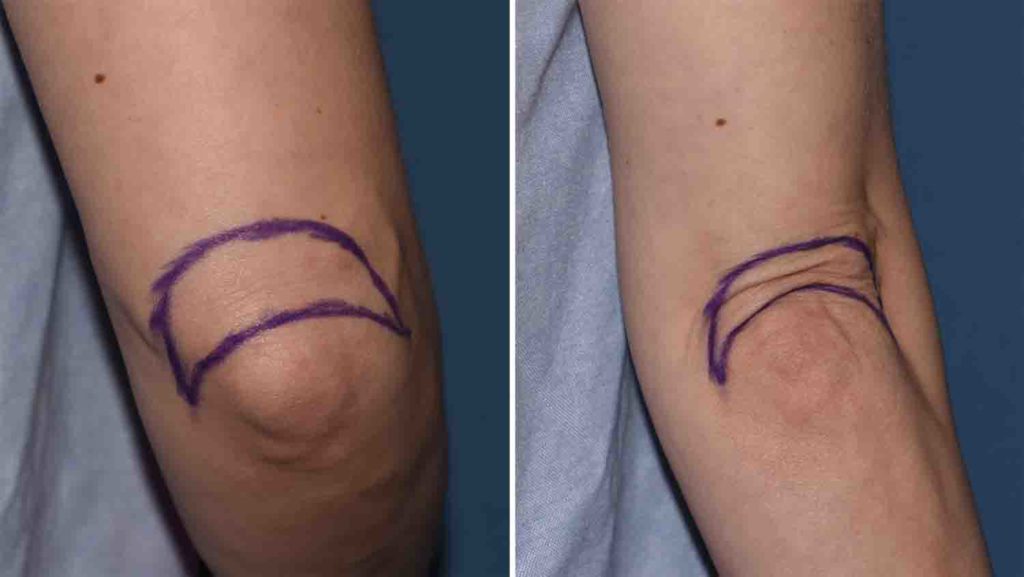 Plastic Surgery Case Study - Bilateral Elbow Lifts for Extension Skin ...