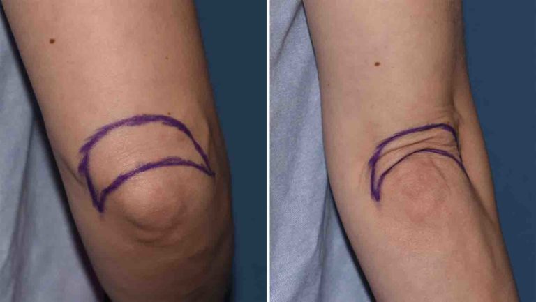 Plastic Surgery Case Study - Bilateral Elbow Lifts for Extension Skin ...