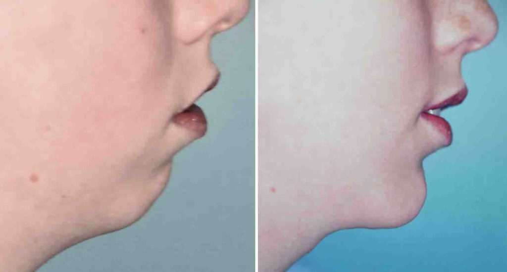 Plastic Surgery Case Study - Teen Sliding Genioplasty and Step-Off ...