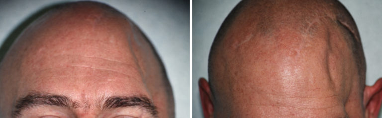 Temporal Craniotomy defect preop Dr Barry Eppley Indianapolis - Explore ...