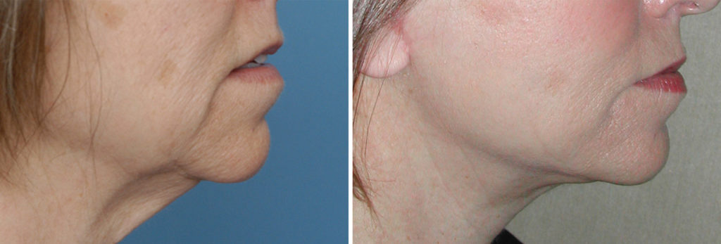 Plastic Surgery Case Study - The Limited Facelift Concept for Moderate ...