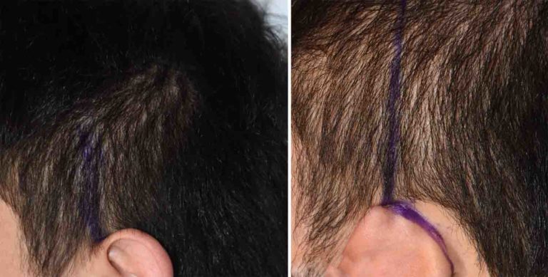 Five Concepts about Temporal Reduction (Wide Head Narrowing Surgery ...