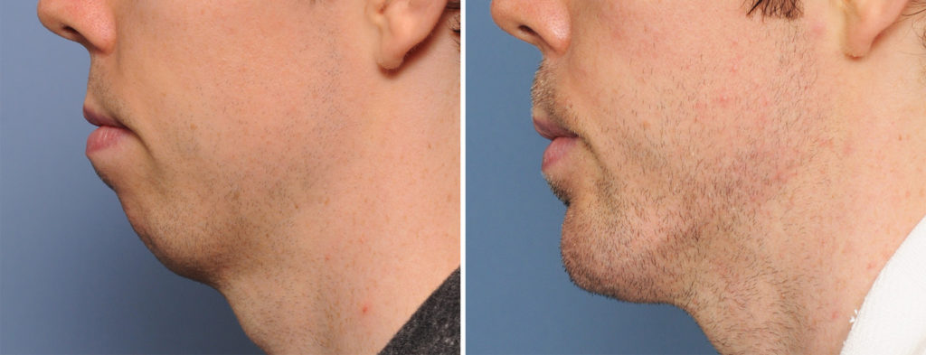 Plastic Surgery Case Study - Sliding Genioplasty Combined with Chin ...
