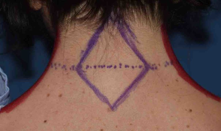 Webbed Neck Correction surgical markings Dr Barry Eppley Indianapolis ...