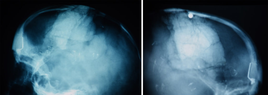 Plastic Surgery Case Study - Hydroxyapatite Reconstruction of Large ...