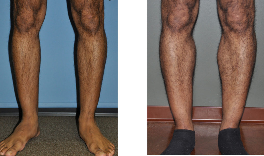 Long-Term Results in Calf Implants - Explore Plastic Surgery