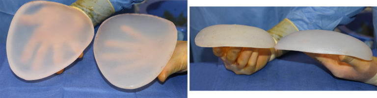 Plastic Surgery Case Study - Custom Pectoral Implant Replacements for ...