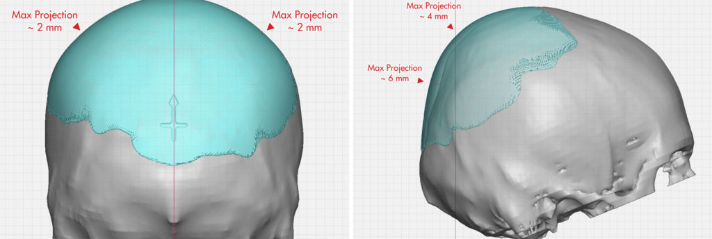 Custom Occipital Implant measurements Dr Barry Eppley Indianapolis ...