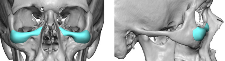 Plastic Surgery Case Study - Vertical Heightening Custom Infraorbital ...