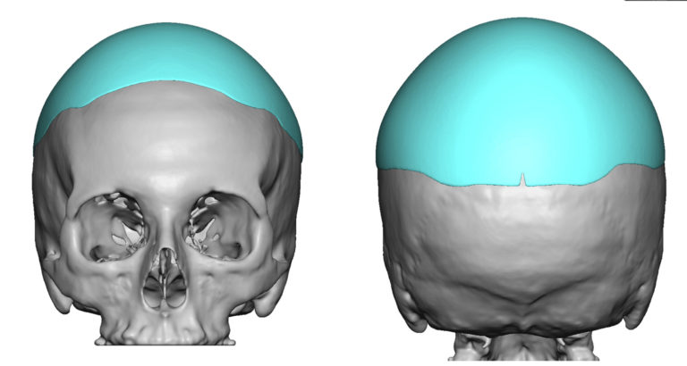 Plastic Surgery Case Study - A Standard Preformed Skull Implant for ...