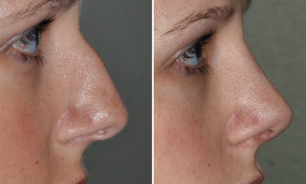 Dorsal Line Modifications in Rhinoplasty - Explore Plastic Surgery