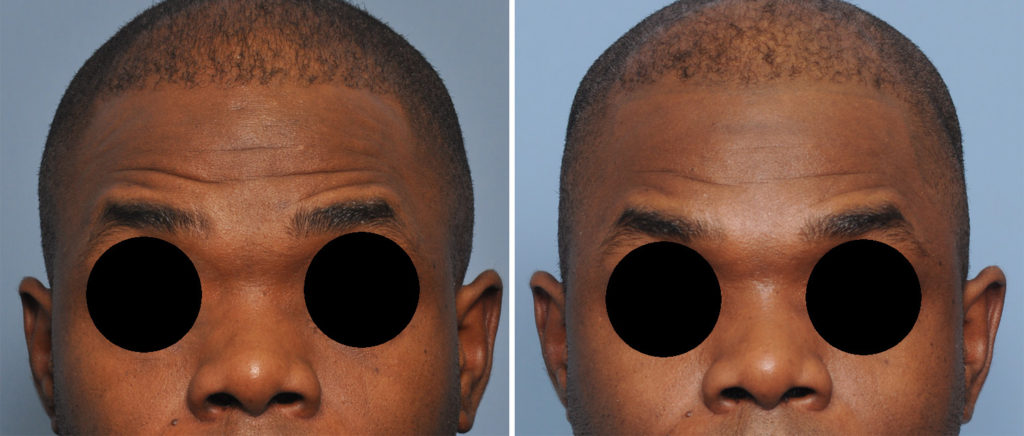 Posterior Temporal Reduction (Head Width Narrowing) result Dr Barry ...