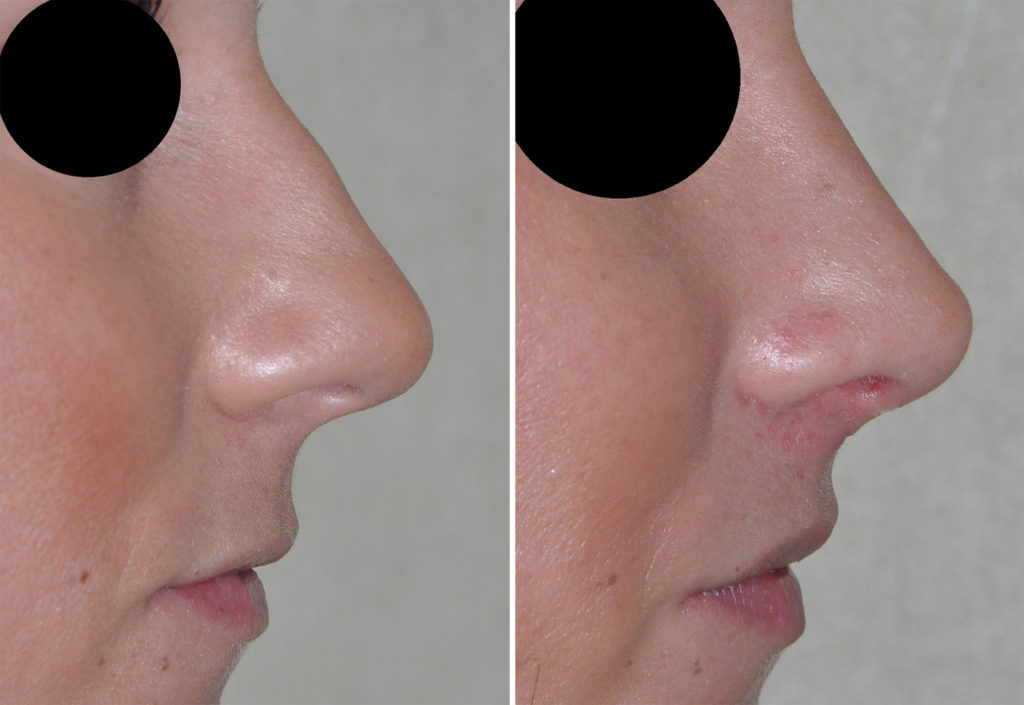 Rhinoplasty with Subnasal Lip Lift result side view Dr Barry Eppley ...