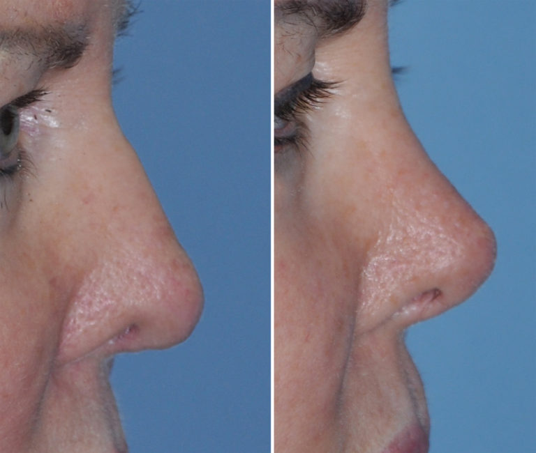 Dorsal Line Modifications in Rhinoplasty - Explore Plastic Surgery