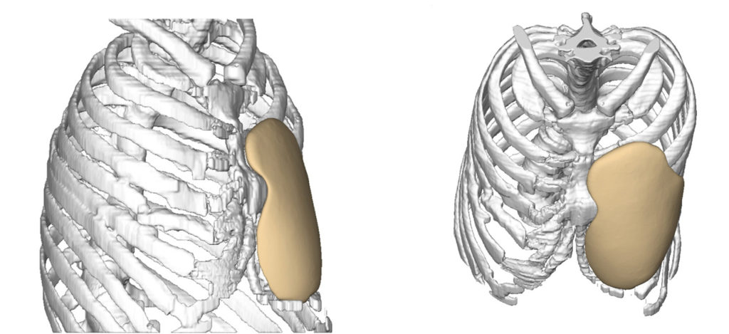 Plastic Surgery Case Study - Custom Chest Wall Implant as a Breast ...