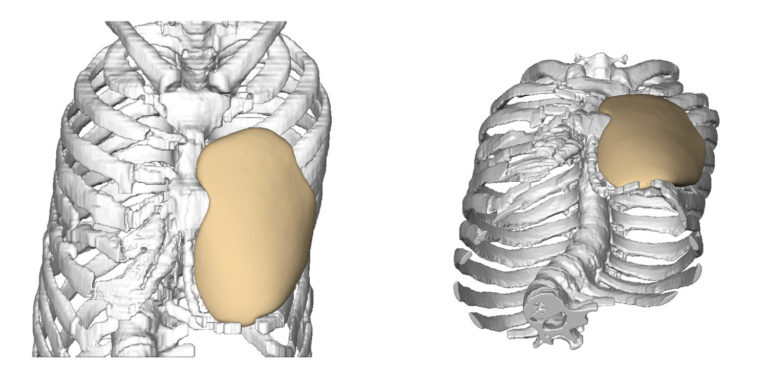 Plastic Surgery Case Study - Custom Chest Wall Implant as a Breast ...
