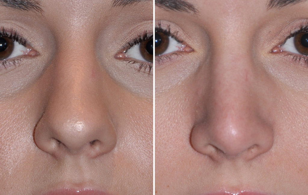 Dorsal Hump Rhinoplasty result front view Dr Barry Eppley Indianapolis ...