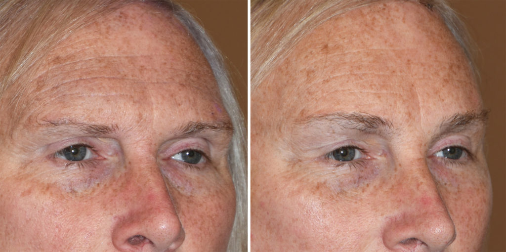 Plastic Surgery Case Study - Microplate Fixation of Transgender Brow ...