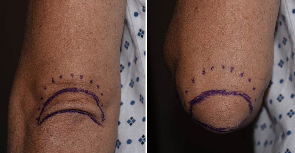 Plastic Surgery Case Study - Male Elbow Lifts for Excess Skin in Arm ...