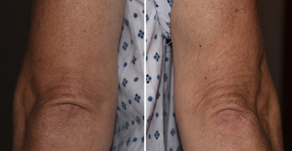 Plastic Surgery Case Study - Male Elbow Lifts for Excess Skin in Arm ...