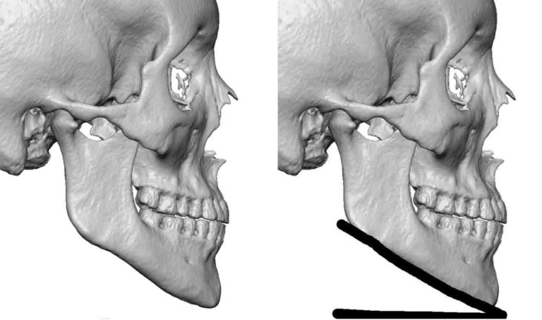 Plastic Surgery Case Study - Aesthetic Correction of the High Angle Jaw ...