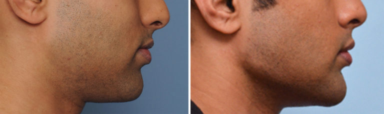 Plastic Surgery Case Study - Remove and Replace Custom Jawline Implant ...