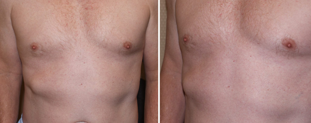 Right Subcostal Rib Protrusion Dr Barry Eppley Indianapolis - Explore ...