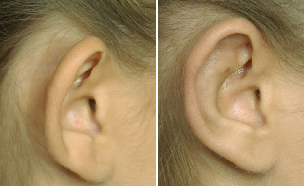 Plastic Surgery Case Study - Otoplasty Surgery for Protruding Ears ...