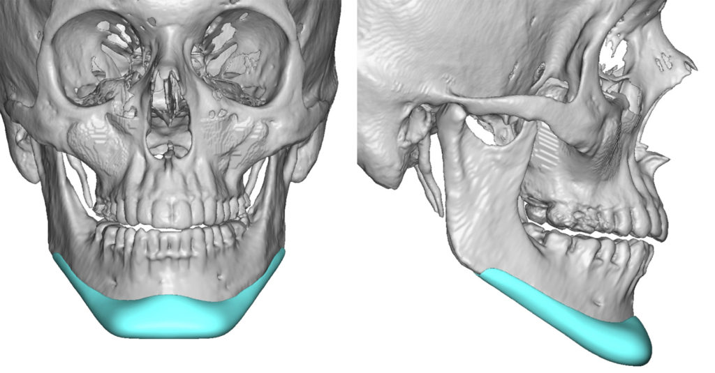 Plastic Surgery Case Study - Custom Extended Square Vertical ...