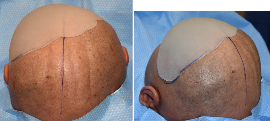 Plastic Surgery Case Study - Custom Occipital Skull Implant for ...