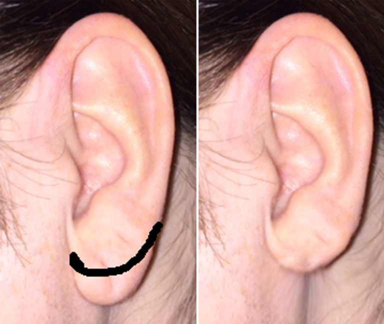 Inferior Helical Rim Earlobe Reduction Earlobe technique Dr Barry ...