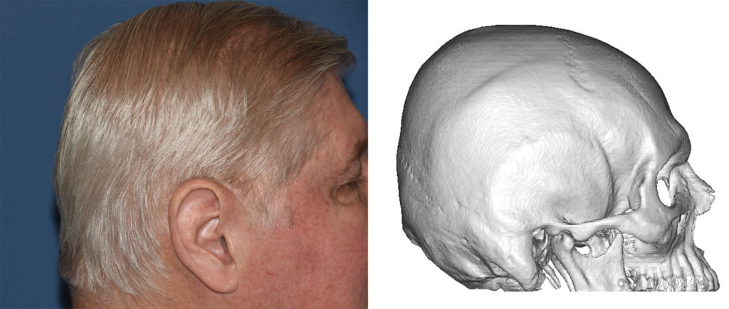 Plastic Surgery Case Study - Older Male Skull Augmentation with Two ...
