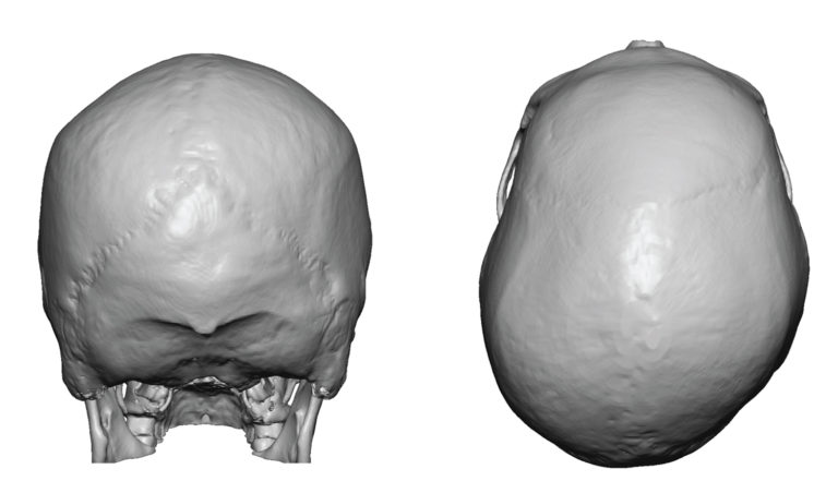 Occipital Plagiocephaly Skull Deformity Dr Barry Eppley Indianapolis ...
