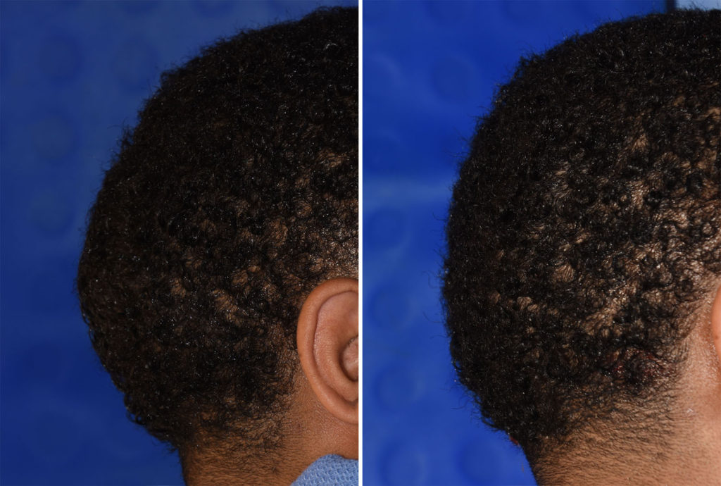 Plastic Surgery Case Study - The Grid Technique for Occipital Skull ...