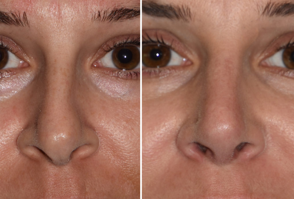 Plastic Surgery Case Study - Rhinoplasty for the Long Thin Nose ...