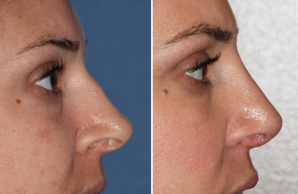 Plastic Surgery Case Study - Rhinoplasty for the Long Thin Nose - Explore Plastic Surgery