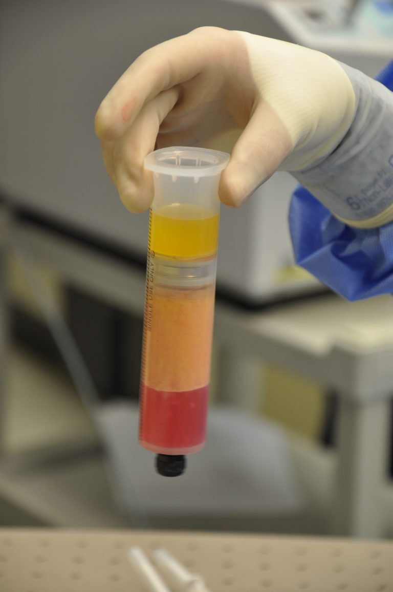 The Role of Graft Preparation in Fat Injection Augmentation - Explore ...