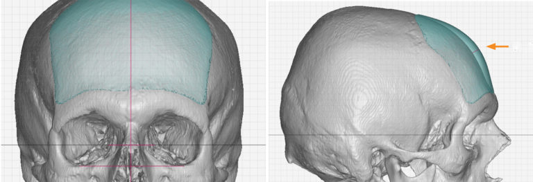 The Custom Forehead Implant for Changing the Slope of the Forehead ...