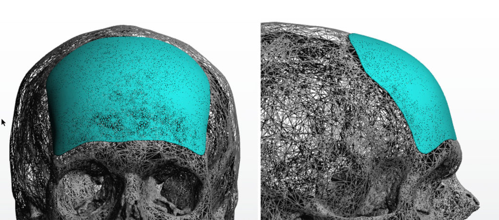 The Custom Forehead Implant for Changing the Slope of the Forehead ...