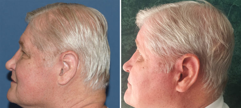 Clinic Snapshots - Large Custom Skull Implant for Flat Back of the Head ...