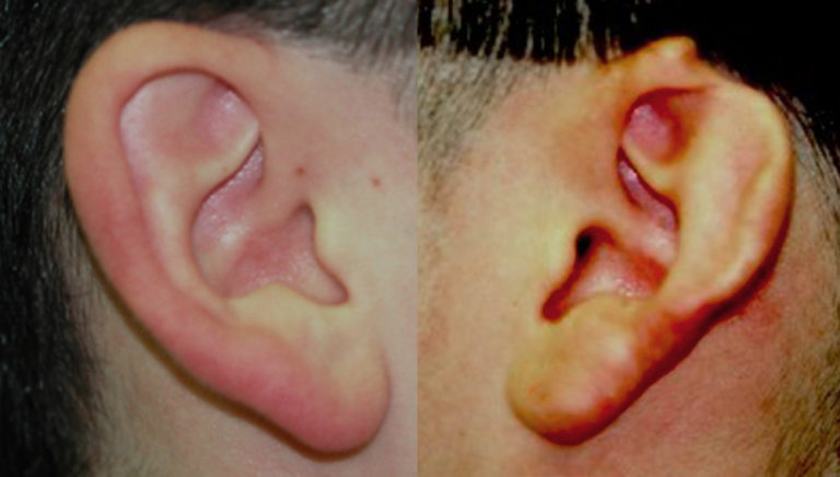 Plastic Surgery Case Study - Ear Reconstruction with Skin Flap and ...