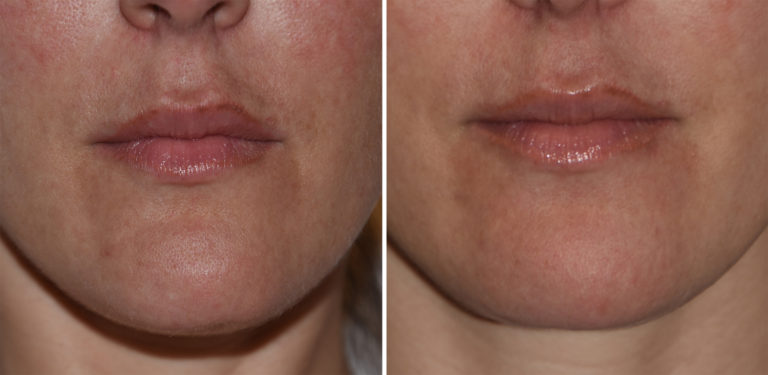 Plastic Surgery Case Study - Female Submental Chin Reduction - Explore ...