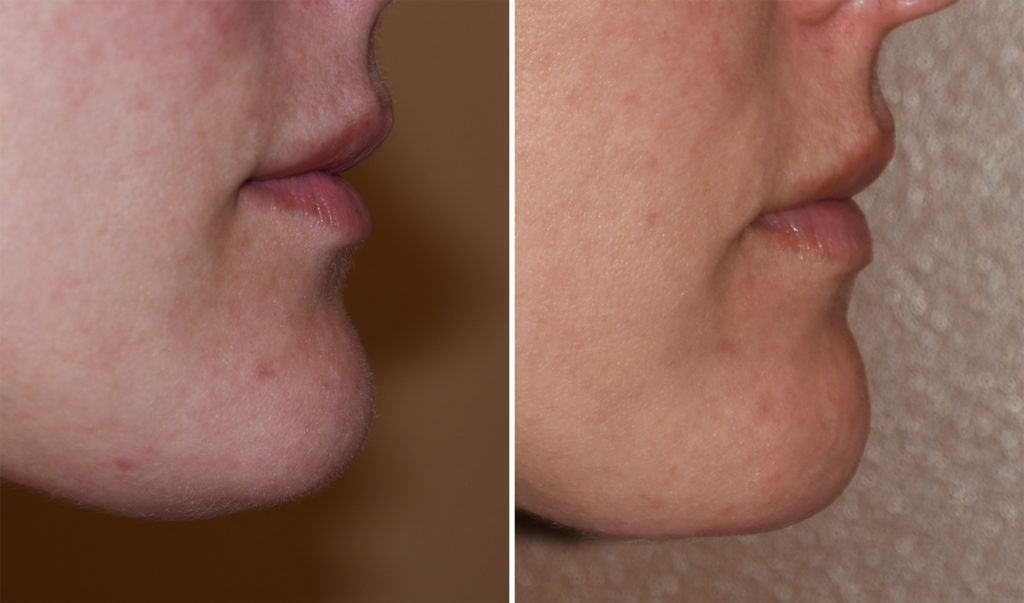 Plastic Surgery Case Study - Female Submental Chin Reduction - Explore ...