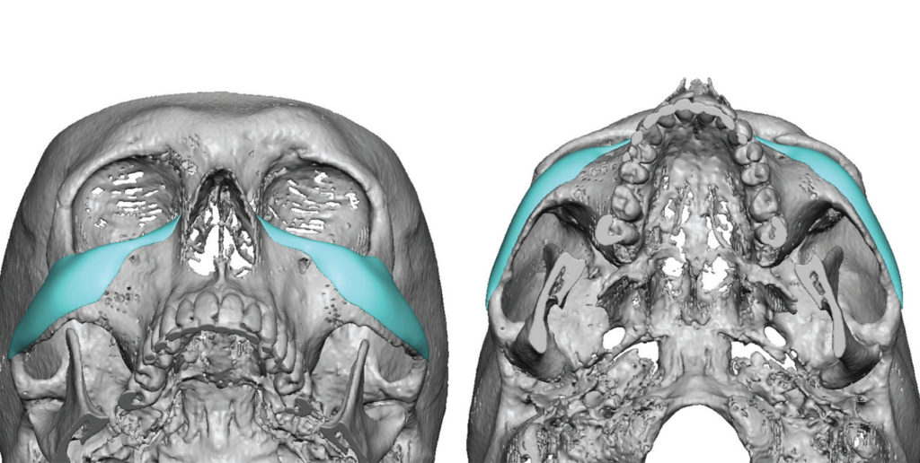 The Anatomic Basis for Custom Infraorbital-Malar Implants - Explore ...