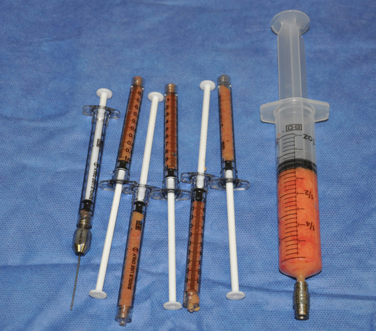 The Role of Stem Cells in Injectable Fat Grafting - Explore Plastic Surgery