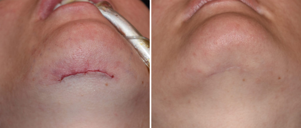 Plastic Surgery Case Study - Female Submental Chin Reduction - Explore ...