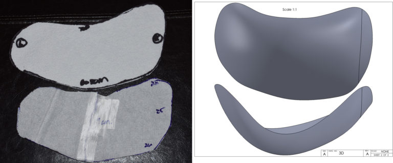 Plastic Surgery Case Study - A Skull Implant Used for Correction of a ...